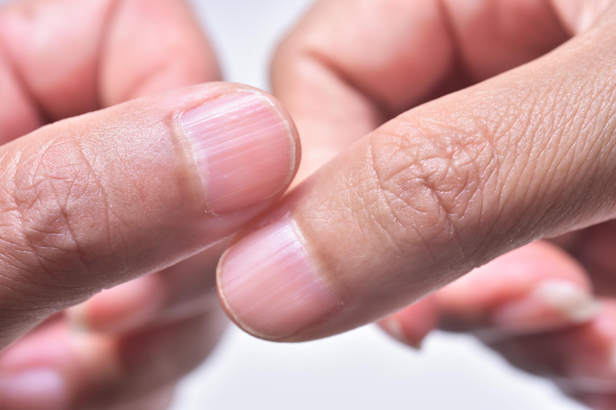 What Do Vertical Ridges On Toenails Mean Design Talk